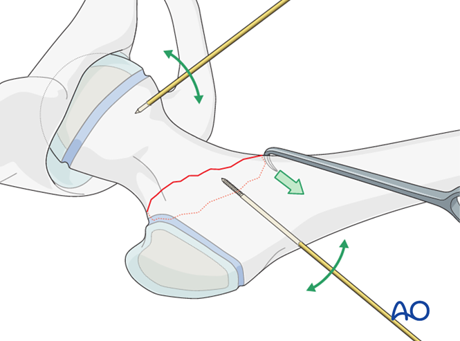 Open reduction, screw fixation for Complete basicervical, simple