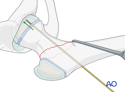 Open reduction, screw fixation for Complete basicervical, simple