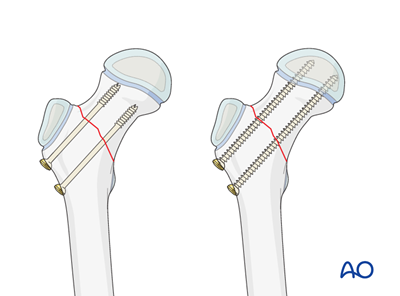 Open reduction, screw fixation for Complete basicervical, simple
