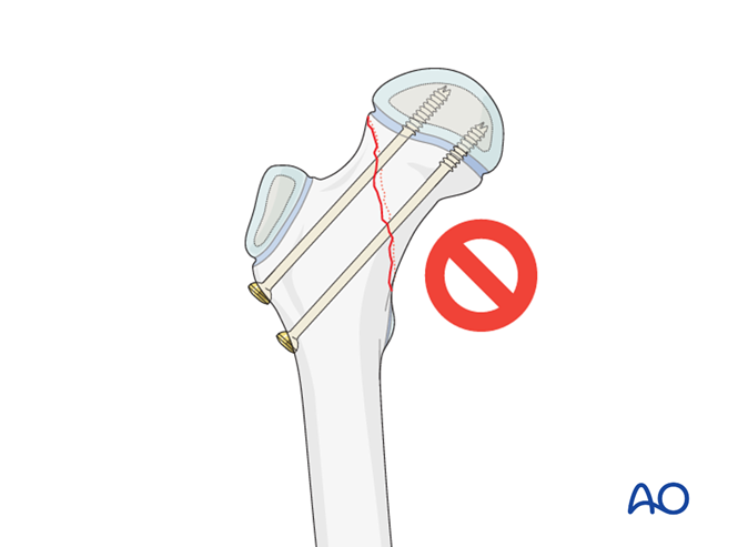 Open reduction, screw fixation for Complete basicervical, simple