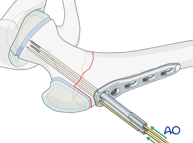 Open reduction, pediatric hip locking plate for Complete ...