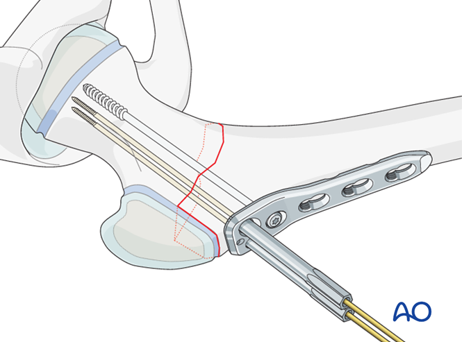 Open reduction, pediatric hip locking plate for Complete ...