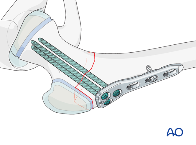 Open reduction, pediatric hip locking plate for Complete ...
