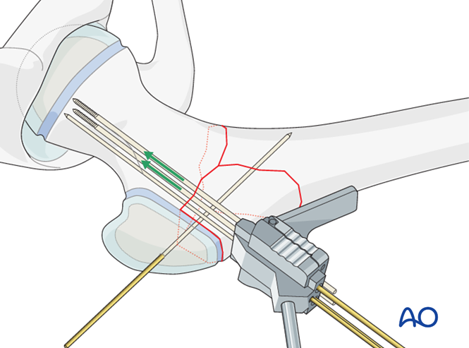 Open reduction, pediatric hip locking plate for Complete ...