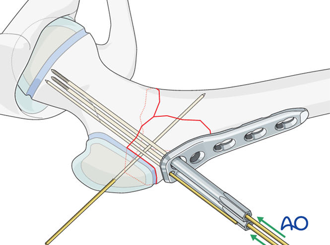 Open reduction, pediatric hip locking plate for Complete ...