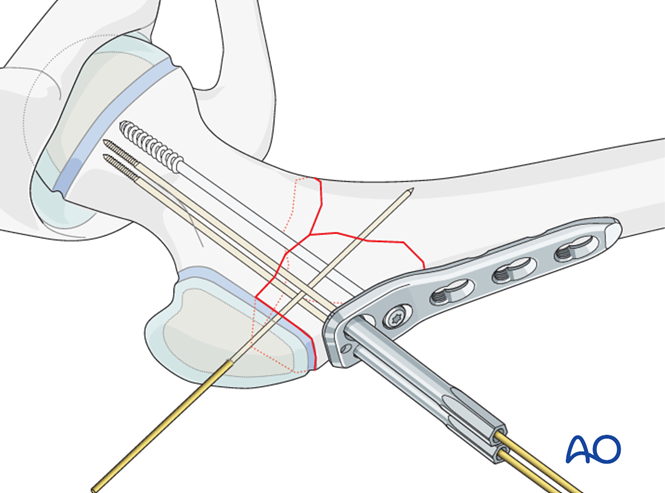 Open reduction, pediatric hip locking plate for Complete ...