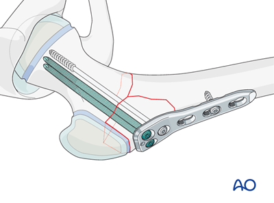 Open reduction, pediatric hip locking plate for Complete ...