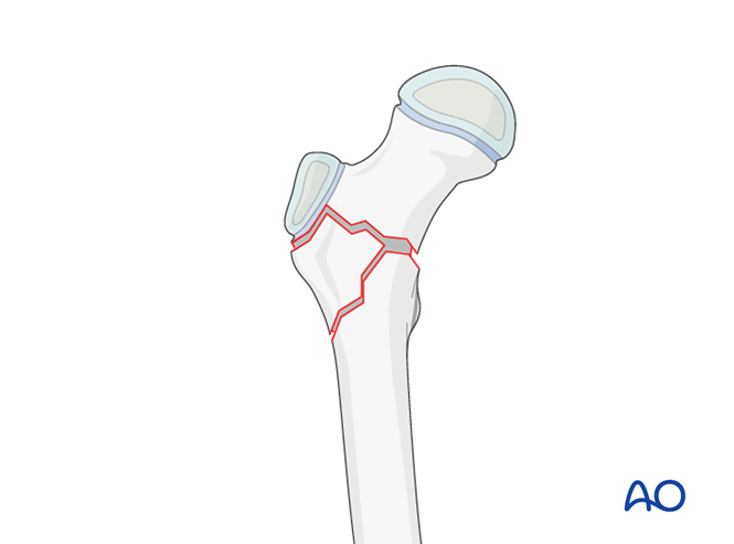 ESIN for Complete transtrochanteric, multifragmentary