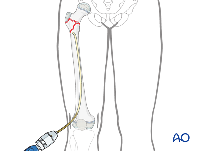 ESIN for Complete transtrochanteric, multifragmentary