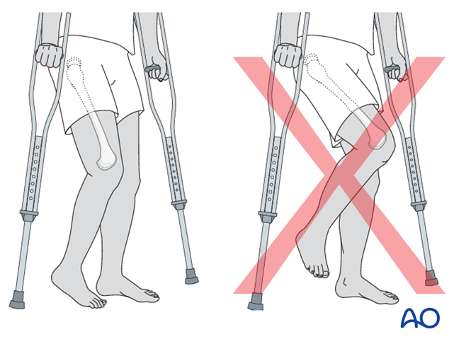 Nonoperative treatment for Avulsion of the greater or lesser trochanter