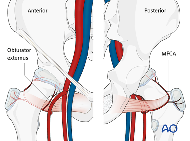 Open vs closed reduction