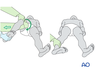 Closed reduction maneuvers