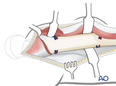 Lateral approach to the pediatric femoral shaft