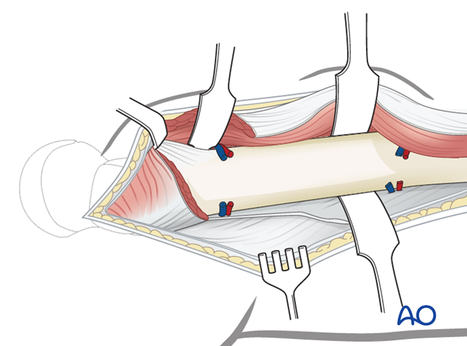 Lateral approach to the pediatric femoral shaft