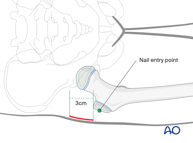 Entry point in the pediatric femur for lateral-entry intramedullary nailing