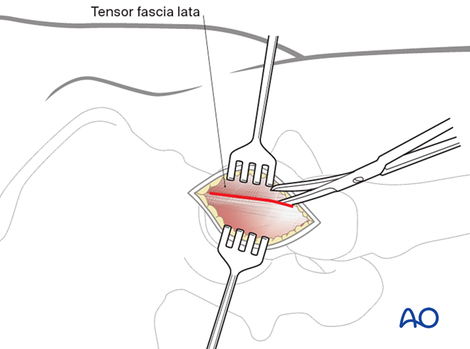 Entry point in the pediatric femur for lateral-entry intramedullary nailing