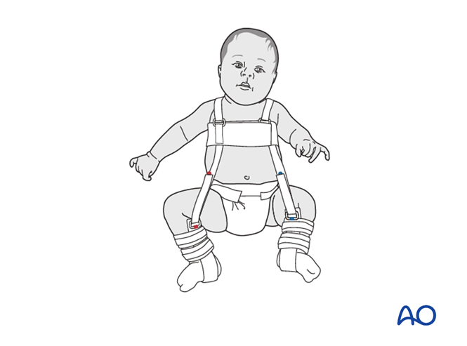 Pavlik harness for Complete transverse, simple