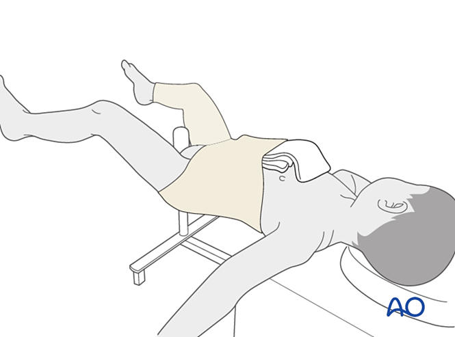 Hip spica casting for Complete oblique or spiral, simple