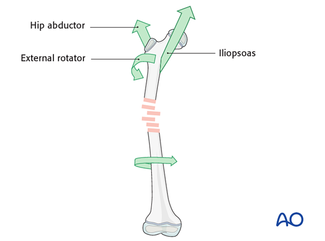 Hip spica casting for Complete oblique or spiral, simple