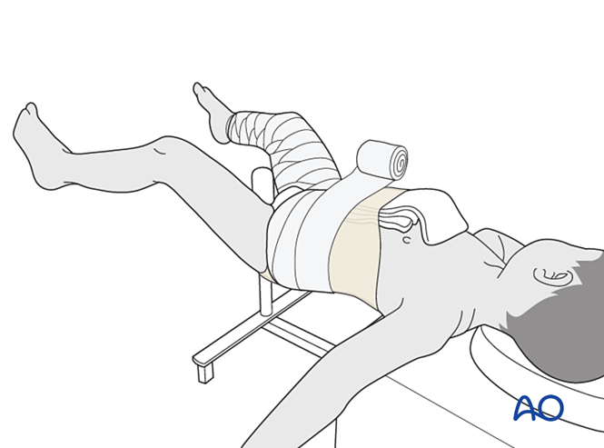 Hip spica casting for Complete transverse, simple