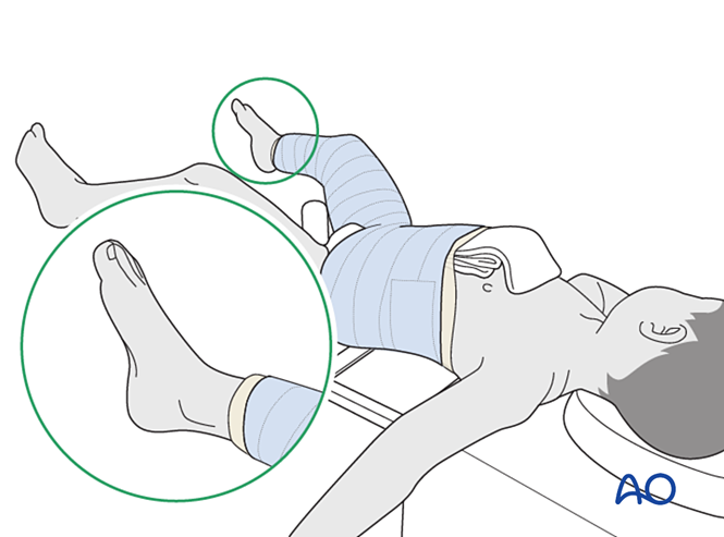 Hip spica casting for Complete transverse, simple