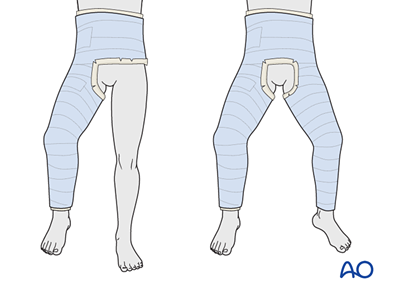 Hip spica casting for Complete transverse, simple