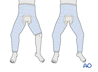 Hip spica casting for Complete oblique or spiral, simple