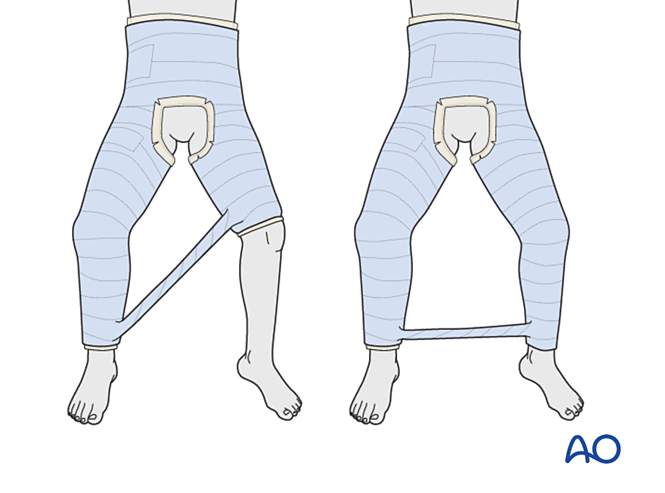 Hip spica casting for Complete oblique or spiral, simple