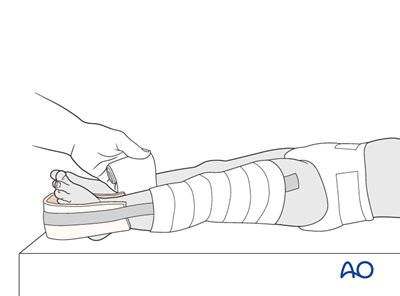 Traction for Complete transverse, simple