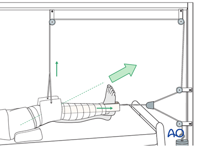 Traction for Complete transverse, simple