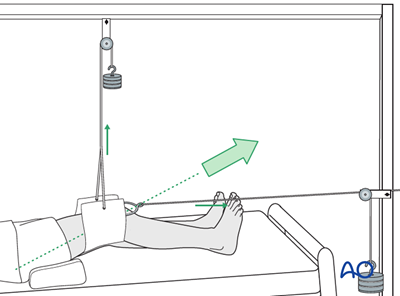 Traction for Complete transverse, simple