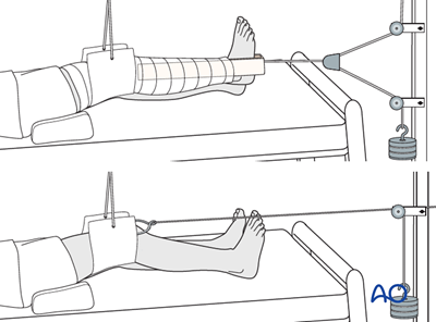 Traction for Complete transverse, simple