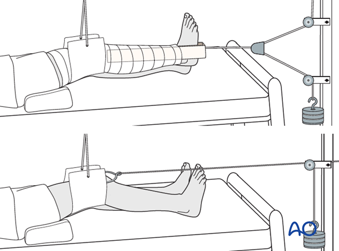 Traction for Complete transverse, simple