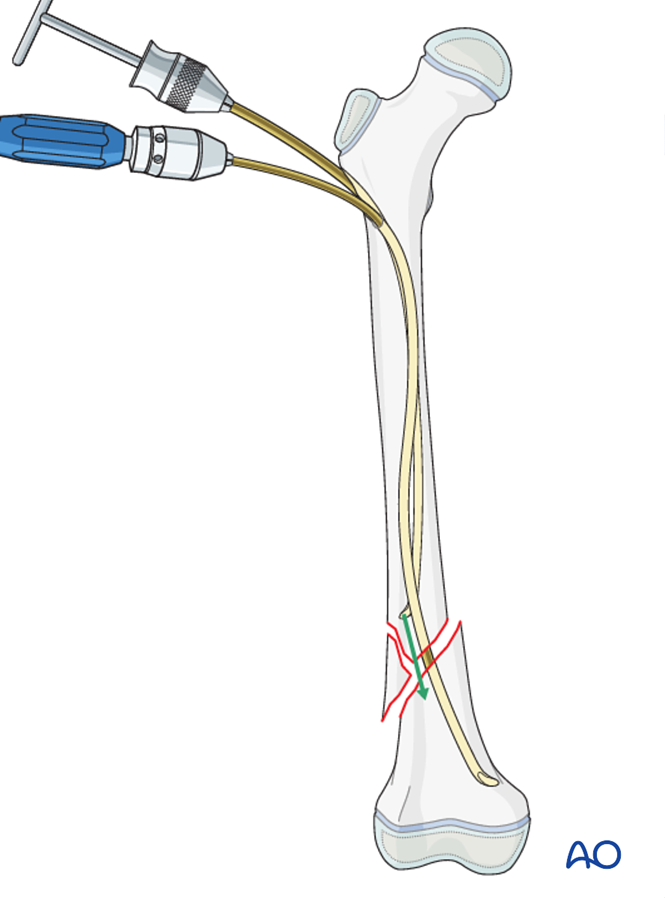 ESIN (antegrade) for Multifragmentary