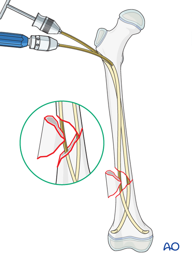 ESIN (antegrade) for Multifragmentary