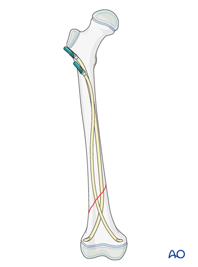 ESIN (antegrade) for Complete oblique or spiral, simple