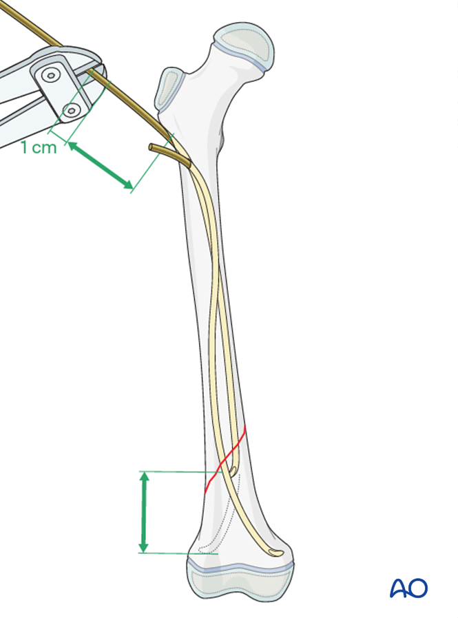 ESIN (antegrade) for Complete oblique or spiral, simple