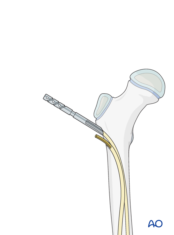 ESIN (antegrade) for Complete oblique or spiral, simple