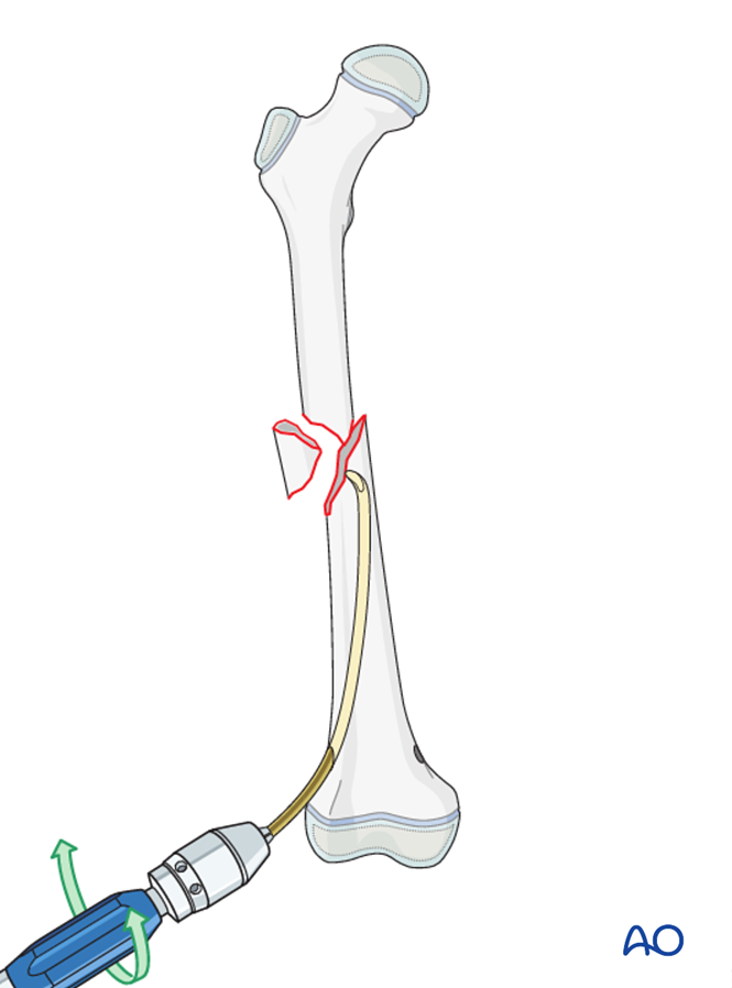 ESIN (retrograde) for Multifragmentary