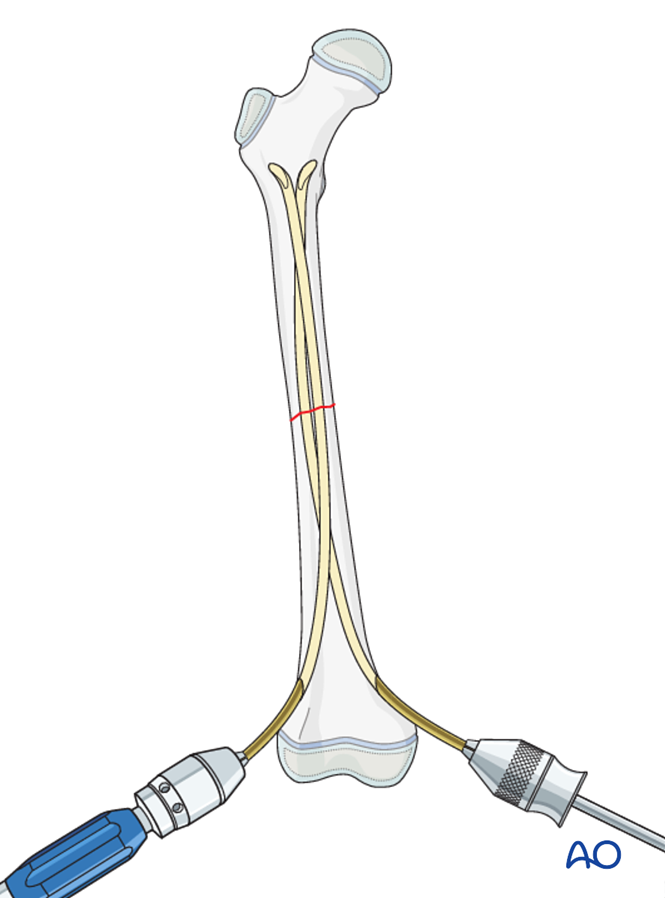 ESIN (retrograde) for Complete transverse, simple