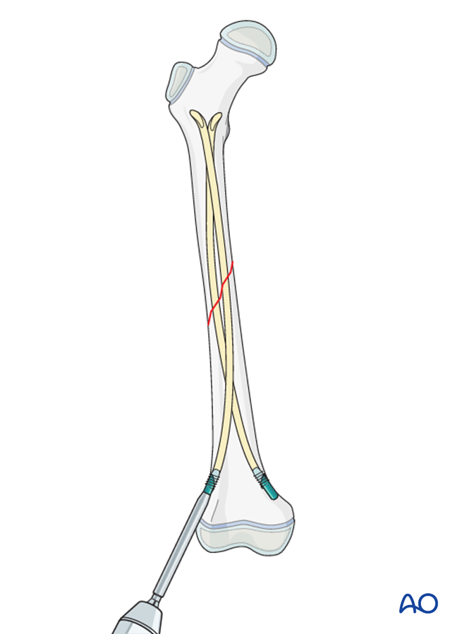 ESIN (retrograde) for Complete oblique or spiral, simple