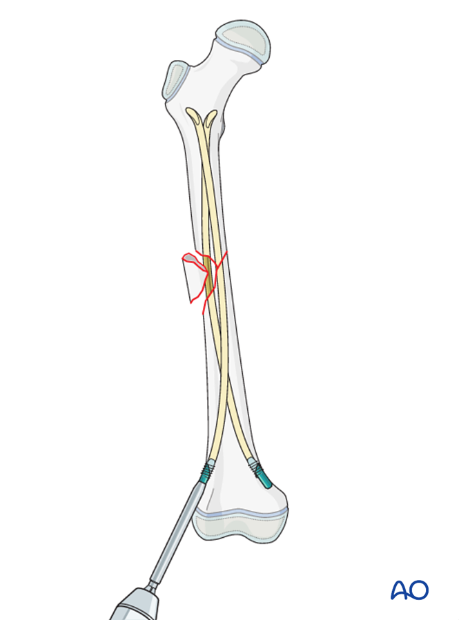 ESIN (retrograde) for Multifragmentary