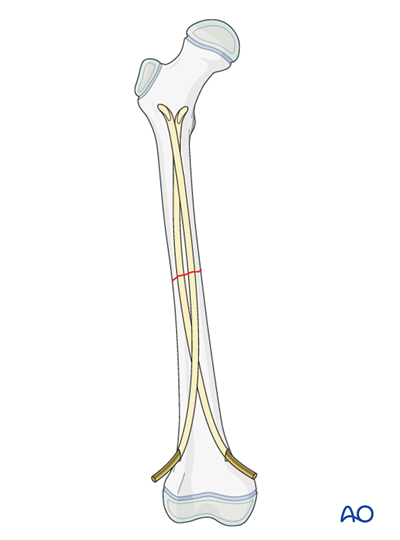 ESIN (retrograde) for Complete transverse, simple