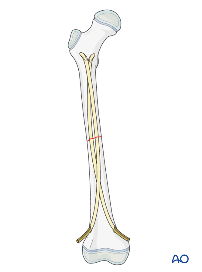 ESIN (retrograde) for Complete transverse, simple