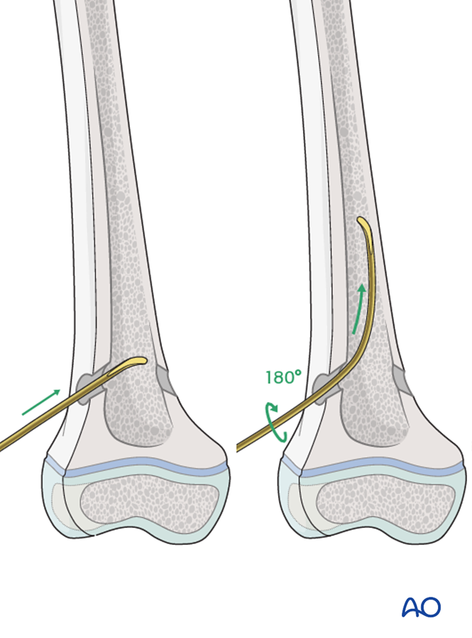 ESIN (retrograde) for Complete transverse, simple