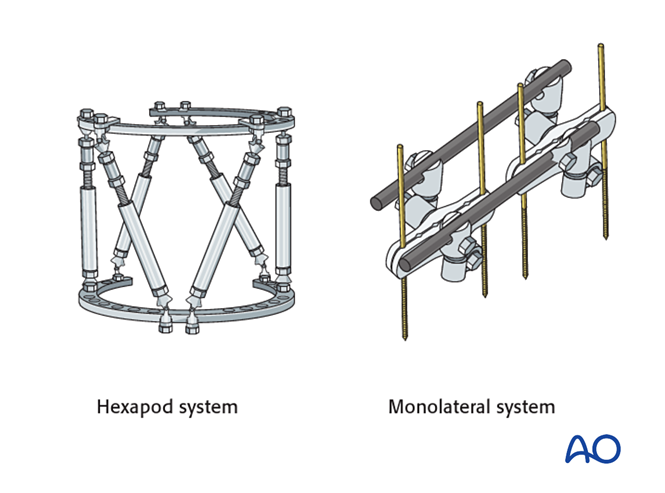 External fixation for Complete transverse, simple
