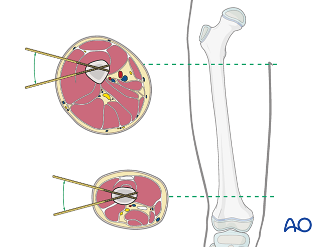 External fixation for Complete transverse, simple