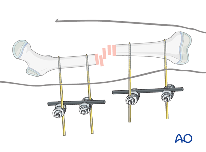 External fixation for Complete transverse, simple
