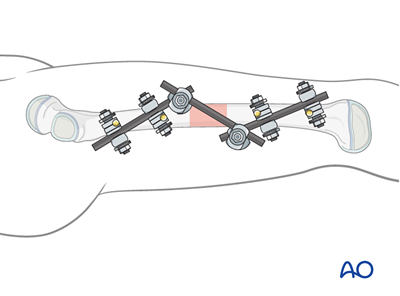 External fixation for Complete transverse, simple