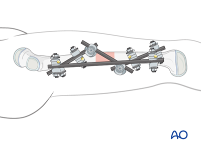 External fixation for Complete transverse, simple